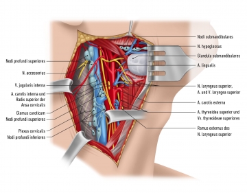 Anatomy Dolichoarteriopathy Severe Kinking With Luminal Narrowing