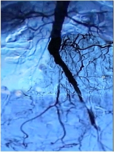 Perioperative management - Aortobifemoral bypass for peripheral ...