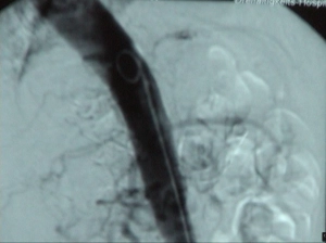 Perioperative management - Iliacomesenteric venous bypass in superior ...