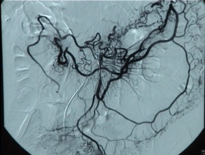 Perioperative management - Iliacomesenteric venous bypass in superior ...