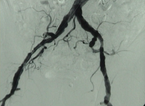 Perioperative management - Right femoropopliteal PTFE bypass (P3 ...