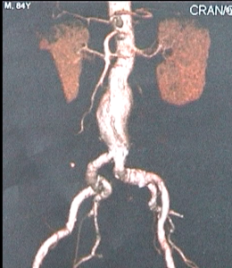 Perioperative management - EVAR – Endovascular repair of abdominal aortic aneurysm (Y-graft ...