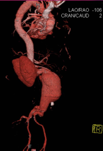 Perioperative management - EVAR – Endovascular repair of abdominal aortic aneurysm (Y-graft ...