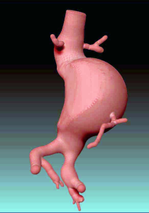 Perioperative management - EVAR – Endovascular repair of abdominal aortic aneurysm (Y-graft ...