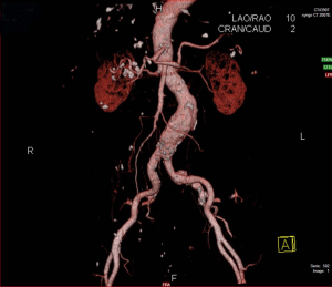 Perioperative management - EVAR – Endovascular repair of abdominal aortic aneurysm (Y-graft ...