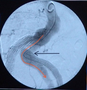 Perioperative management - Interventional management of type Ia ...
