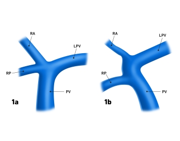 Anatomy - Cholecystectomy, laparoscopic