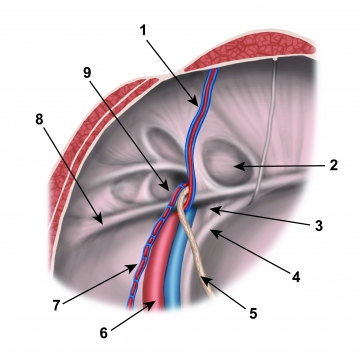 Anatomy - Transabdominal preperitoneal patch (TAPP) repair of inguinal hernia
