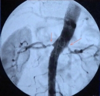 Perioperative management - Percutaneous transluminal angioplasty (PTA ...
